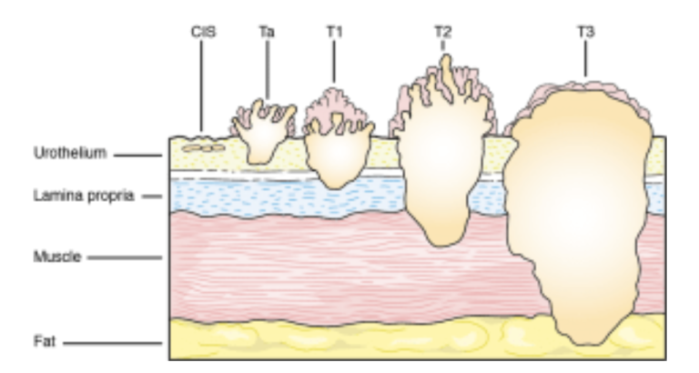 Bladder Cancer Types, Stages & Grades – Bladder Cancer Advocacy Network