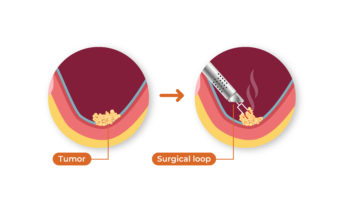 Understanding TURBT: Bladder Tumor Removal Surgery | BCAN