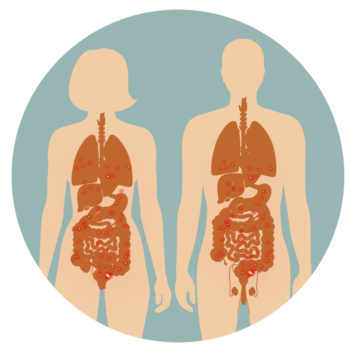 Advanced Bladder Cancer | BCAN