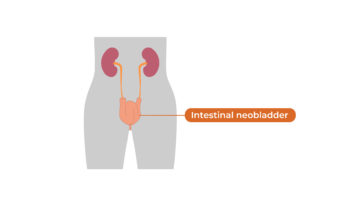 Urinary Diversion: What Is It? What Are My Options? | BCAN