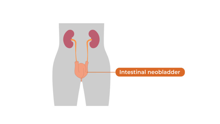 Urinary Diversion: What Is It? What Are My Options? | BCAN