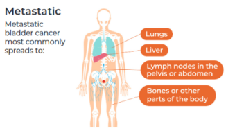 Advanced Bladder Cancer | BCAN