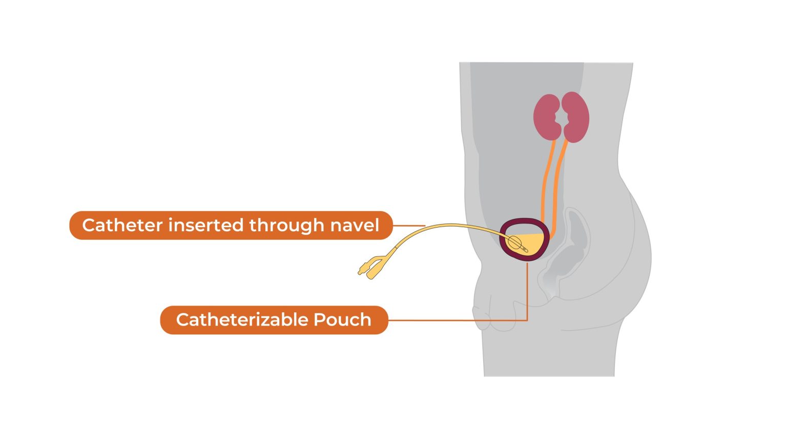 Urinary Diversion – Bladder Cancer Advocacy Network