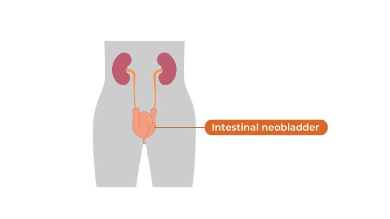 Urinary Diversion – Bladder Cancer Advocacy Network