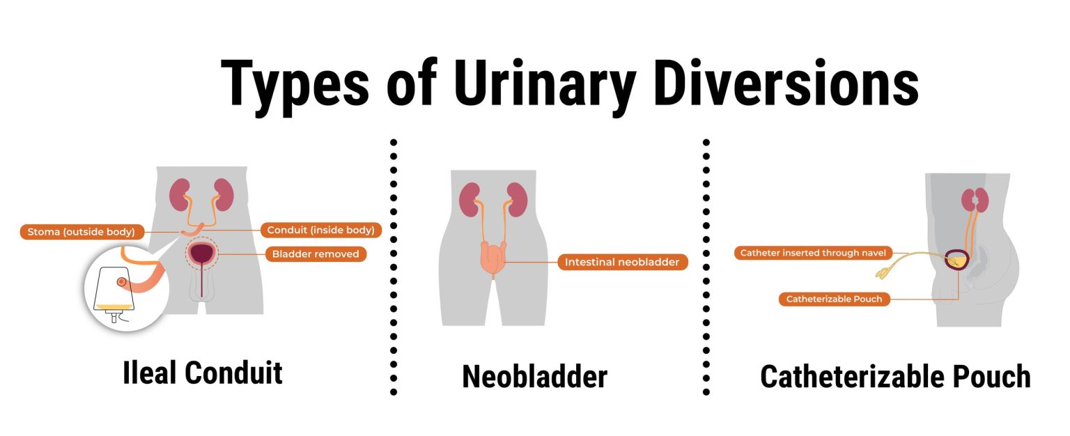 Urinary Diversion – Bladder Cancer Advocacy Network
