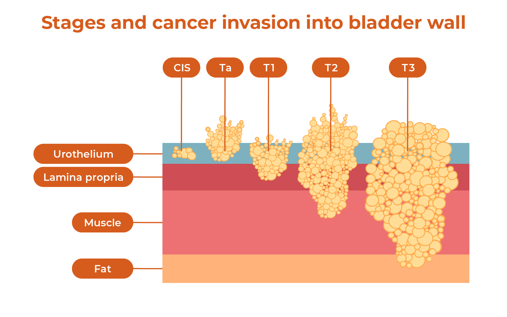 Bladder Cancer Stages | Bladder Cancer Advocacy Network