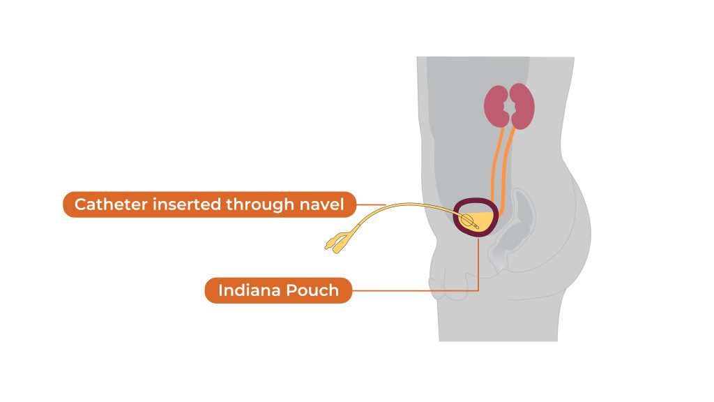 Urinary Diversion: What Is It? What Are My Options? | BCAN