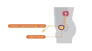 Urinary Diversion: What Is It? What Are My Options? | BCAN